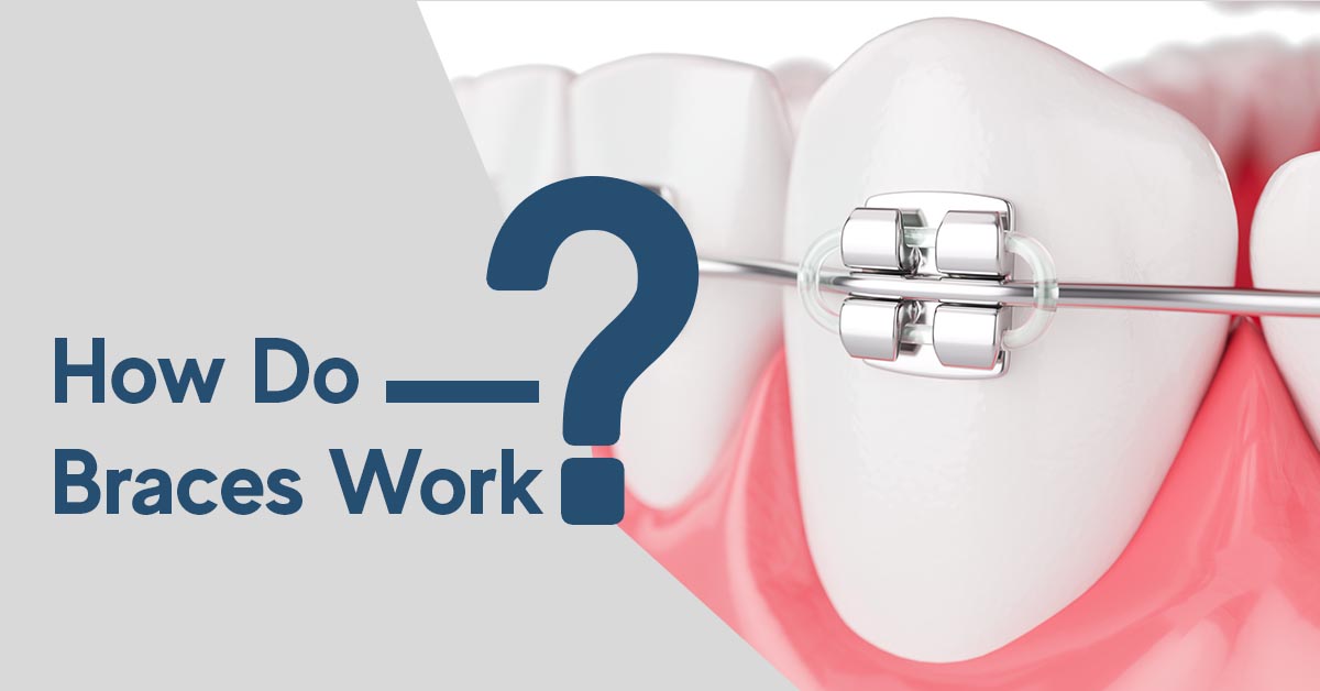 How Do Braces Work – Stephenson Orthodontics Blog