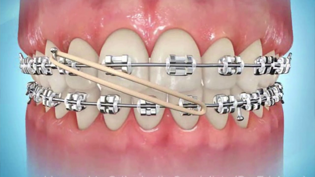 Understanding Orthodontic Elastics: Types and Uses – Stephenson ...