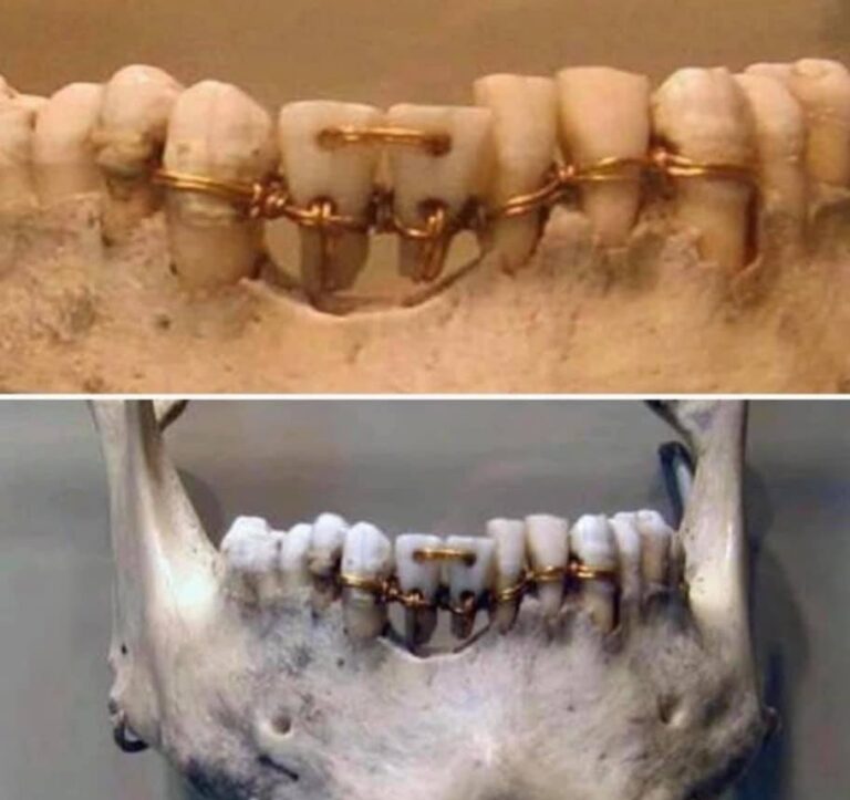 Weird and Wacky Braces Facts You Never Knew! – Stephenson Orthodontics Blog